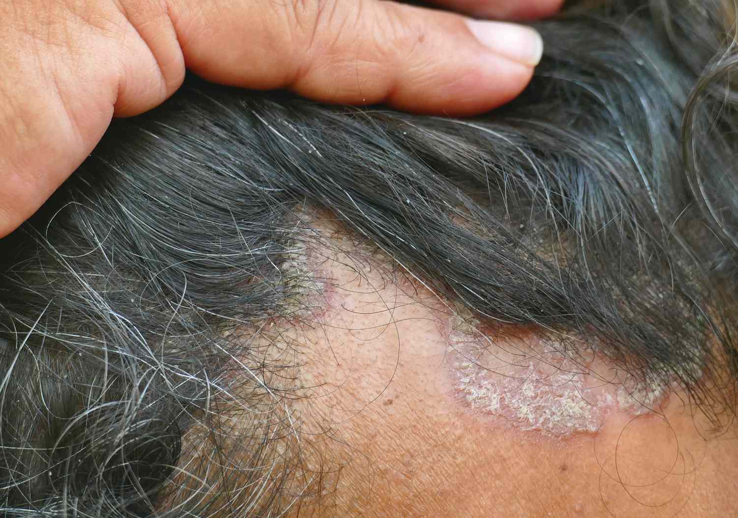 Master Scalp Psoriasis: Effective Management Tips