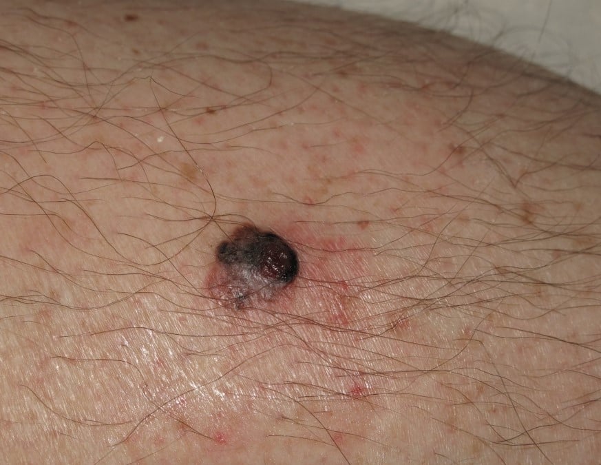 Melanoma Awareness: Spot the Signs and Take Precautions Today